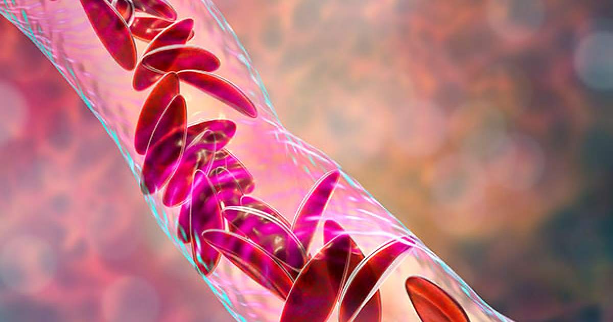 Inherited Blood Disorder | AMCP.org