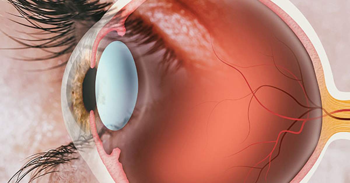 JMCP Road Map - Retinal Disease | AMCP.org